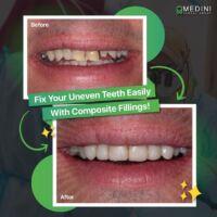 Tooth Filling Procedure: A Step-by-Step Guide