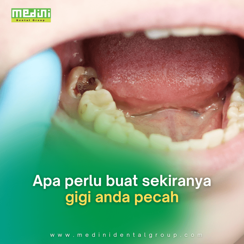Apa Perlu Buat Sekiranya Gigi Anda Pecah
